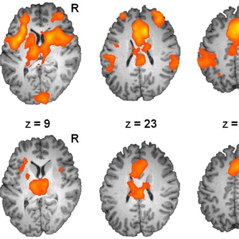Effect Of Selective Attention Task On Brain Activation Brain Regions
