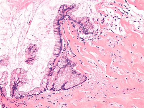 Epithelial Neoplasms Of The Appendix Clinical Tree