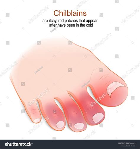 81 Chilblains Feet Royalty Free Photos And Stock Images Shutterstock