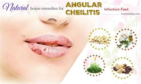 25 Natural Home Remedies For Angular Cheilitis Infection Fast 25 Natural Home Remedies For Angular Cheilitis Infection Fast