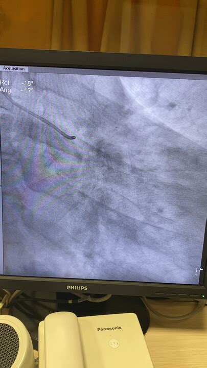 J Cto Score 2 Blunt Stump Calcification Gaia Third Crossed The Lesion… Reza Madadi