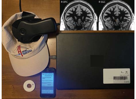 Closed Loop Neurostimulation For Biomarker Driven Personalized Treatment Of Major Depressive
