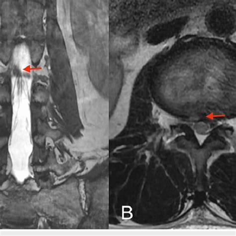 Three Month Postoperative MRI A Although The Position Of The Exiting Download Scientific