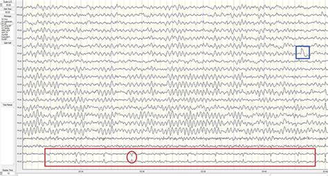 A Guide To Interpreting EEG Topographic Maps
