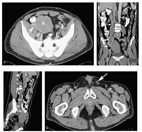 Preoperative Multidetector Computed Tomography Diagnosis Of