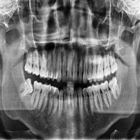 Histopathological Photograph Showing Chronic Abscess With Thick Fibrous