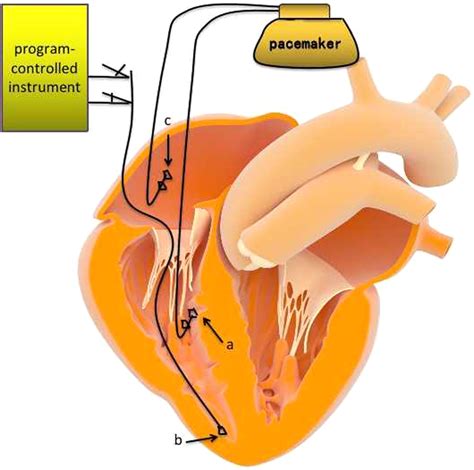 Femoral Vein Temporary Pacing Electrode Application Diagram A