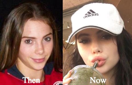 Mckayla Maroney Lip Fillers Latest Plastic Surgery Gossip And News