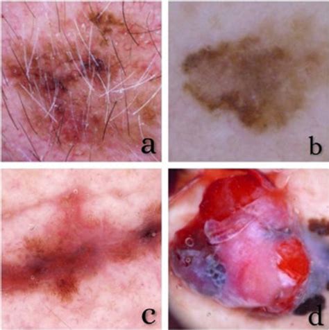 论文审查 Using Computer Vision For Skin Disease Diagnosis In Bangladesh Enhancing Interpretability