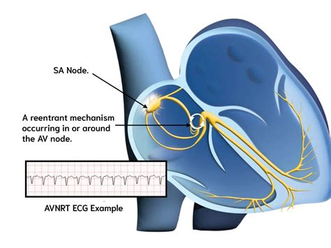 Av Nodal Reentrant Tachycardia Avnrt Symptoms Causes