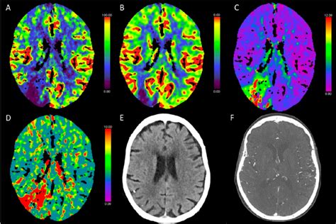 Color Coded Maps Generated From Computed Tomography Perfusion Ctp Of Download Scientific
