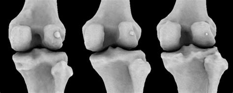 Mysterious Bone Discarded By Evolution Is Making A Comeback In Modern Humans Sciencealert