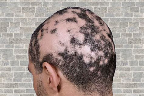 Alopecia Areata Nzuri Restoration Hair Center