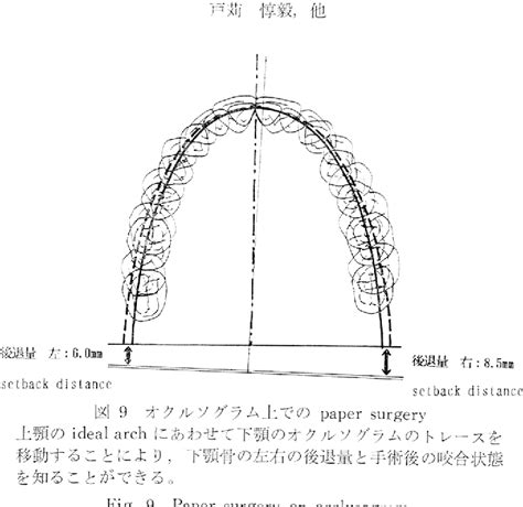 Application Of An Occlusogram For Surgical Orthodontic Case Semantic