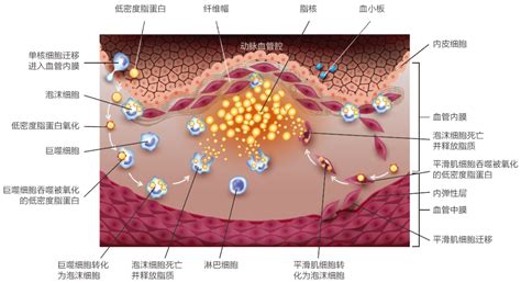动脉粥样硬化到底是怎么回事？看完你就懂了！ 知乎