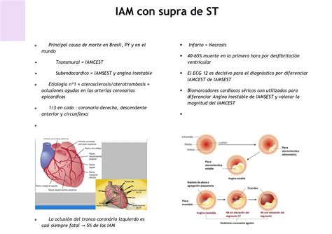 Iamcest Infarto Agudo De Miocardio Con Elevación Del Segmento St