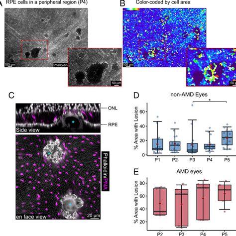 Far Peripheral Rpe Subpopulation P5 Contains Sub Rpe Deposits Download Scientific Diagram