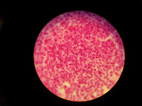 Cuáles Son Las Razones Por Las Que Crecen Los Casos De Infecciones De