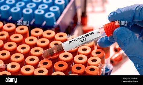 Mononucleosis Blood Test Conceptual Image Stock Photo Alamy