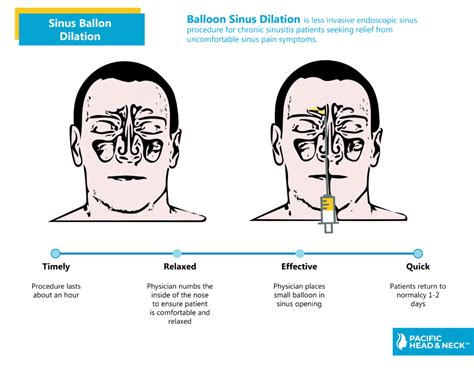 In Office Balloon Sinuplasty Pacific Eye And Ear Specialists