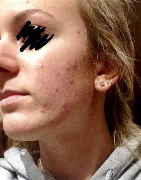 Roaccutane Side Effects 9 Women Share Their Roaccutane Experiences