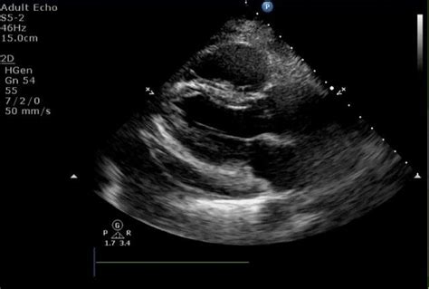2 D Echo Plax View In Post Pericardiocentesis Showing Dilated Right Download Scientific Diagram