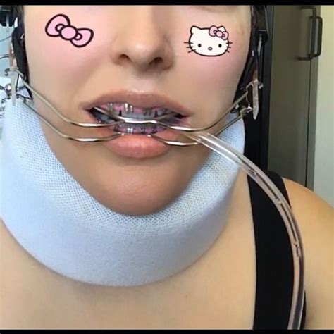 Pin By Jamie Richie On Braces And Retainers Orthodontics Teeth Braces