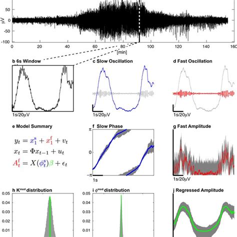 Propofol Induced Unconsciousness In A Human Subject Monitored With Eeg