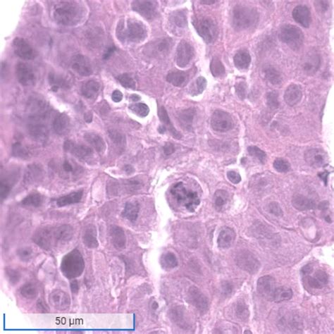 Week 799 Case 2 Johns Hopkins Surgical Pathology Unknown Conference