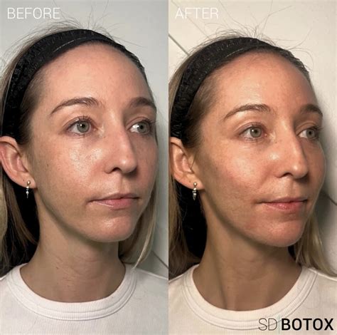 Cheek Filler Before After Photos Sdbotox