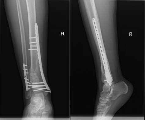 A Unique Adult Type Distal Tibia Non Ossifying Fibroma With Secondary Aneurysmal Bone Cysts