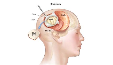 Craniotomy Surgery Cost In India International Patient Care In Delhi