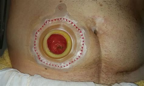 197 Ostomy Care Medical Surgical Nursing Openstax