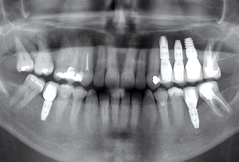 Multiple Socket Preservation In The Maxilla With Collacone® Max Dr D