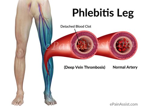 What Is Phlebitis Leg And How Is It Treated
