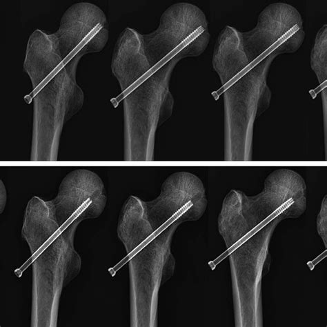Otaao Classification Of Femoral Neck Fractures Download Scientific