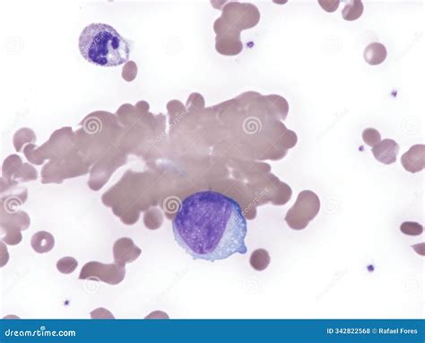 Diffuse Large B Cell Lymphoma Peripheral Blood Stock Photo Image Of Cells Oncology