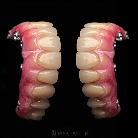 Frketin Nina On Linkedin Hybrid Atlantis Substructure With Sdcl Teeth And Anaxgum Pink