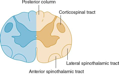 Spinothalamic Tract Lesion