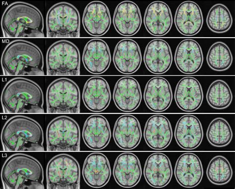 Tbss Analysis Of Scalar Diffusion Tensor Parameters Results Of Tbss Download Scientific