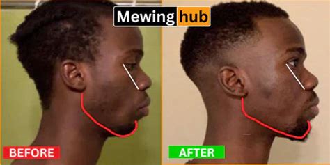 Remarkable One-Year Mewing Transformation: Before and After Analysis ...