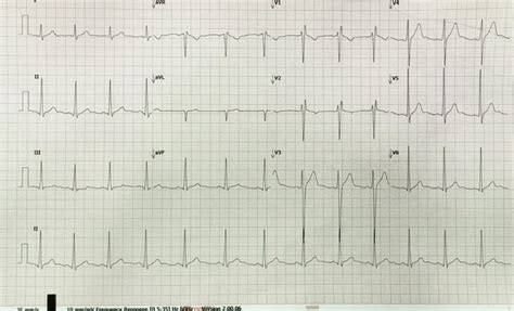 33m Irbbb Qrs Duration 112ms Weird Qrs Complexes In Anterior And Lateral Leads Rekg