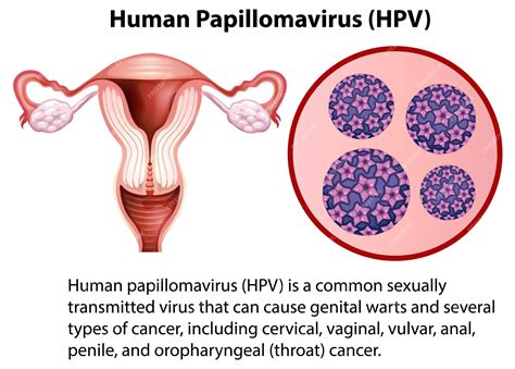 Genital Human Papillomavirus Hpv