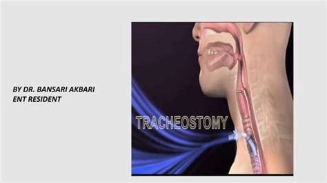 Tonsillectomy Ppt