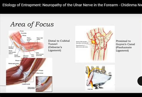 Ulnar Nerve Entrapment