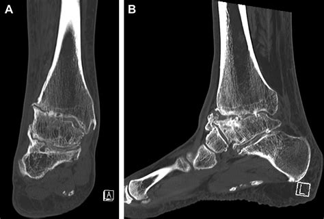 Pantalar Arthrodesis Foot And Ankle Clinics