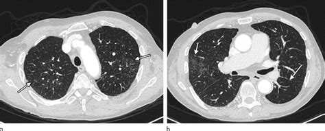 Axial Noncontrast Chest Ct Scans Obtained With Lung Window Settings Download Scientific Diagram