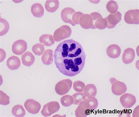 Hypersegmented Neutrophils