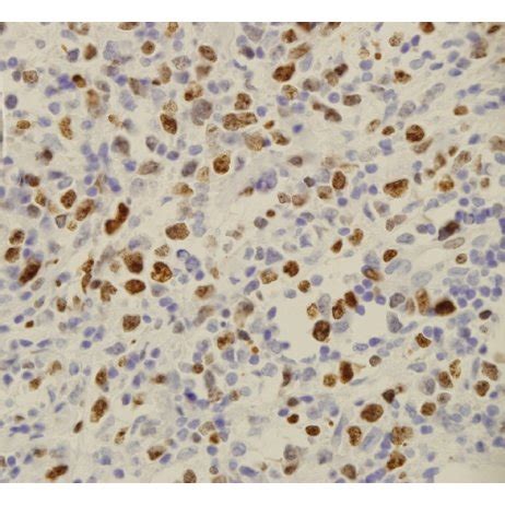 Histopathological Examination Shows Diffuse Dense Infiltration Of Small Download Scientific