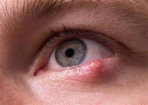 Chalazion Eyelid Cyst Chalazion Treatment